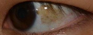 A Closer Look at Birthmarks on the Eye: Causes, Locations, and ...
